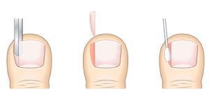 Permanent Toenail Removal | Toronto Foot Care